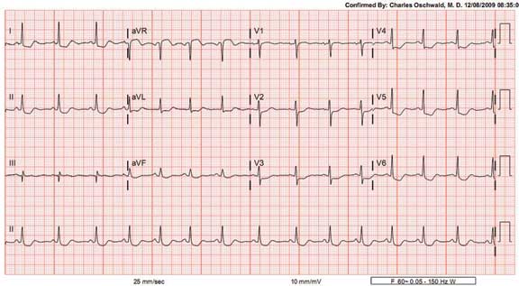 Don’t Forget Lead aVR… | Emergency Physicians Monthly