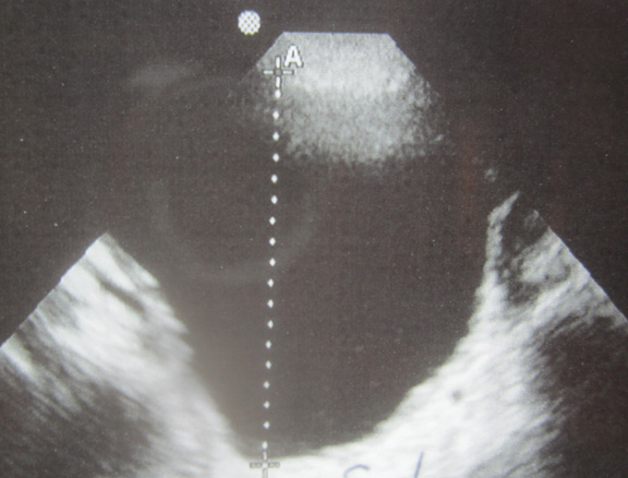Five-Year-Old With Dysuria, Abdominal Pain and Incontinence | Emergency ...
