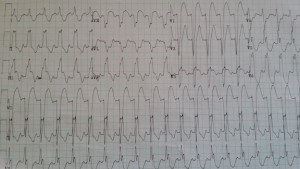 STEMI in the Presence of LBBB | Emergency Physicians Monthly