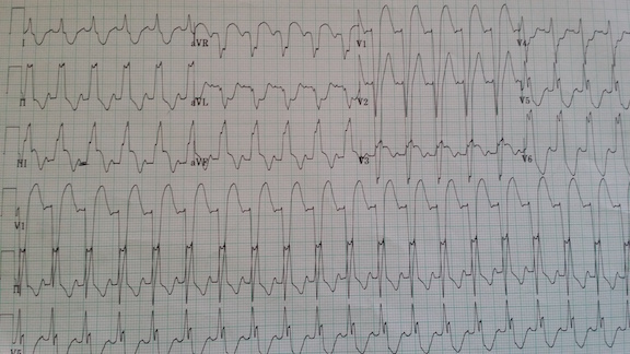 STEMI in the Presence of LBBB | Emergency Physicians Monthly