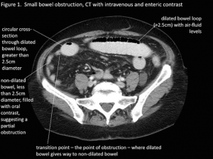 CT of Small Bowel Obstruction | Emergency Physicians Monthly