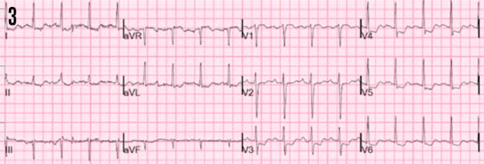 Interactive ECG: A Study in ST Elevation | Emergency Physicians Monthly