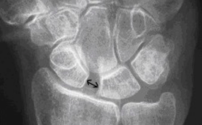 Scaphoid X Ray Angle