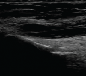 A Novel Approach To Toddler Forearm Fractures | Emergency Physicians ...