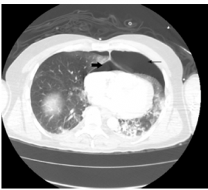 Tension Pneumopericardium From Blunt Force Trauma: Resuscitating the ...