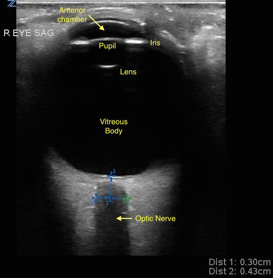 Eye spy a detached retina | Emergency Physicians Monthly