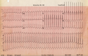 Treating WPW Syndrome | Emergency Physicians Monthly