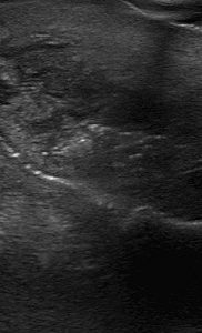 Diagnosing Necrotizing Fasciitis