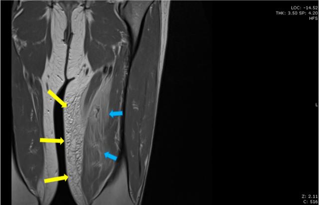 Oh, MYositis! | Emergency Physicians Monthly