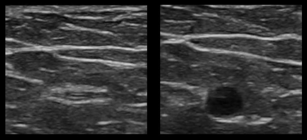 Ultrasound-Guided Peripheral Access: Part 1 | Emergency Physicians Monthly