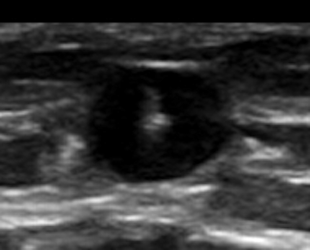 Ultrasound-Guided Peripheral Access: Part 1 | Emergency Physicians Monthly