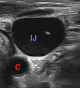 Ultrasound-Guided Peripheral Access: Part 2 | Emergency Physicians Monthly