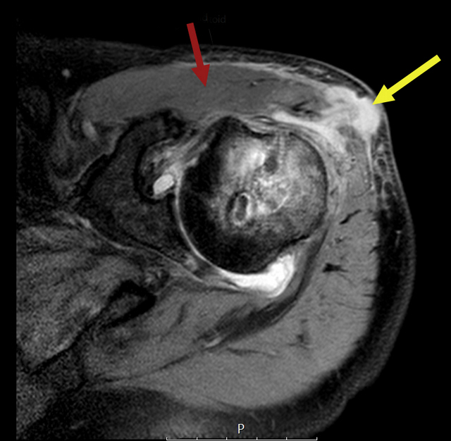 Septic Shoulder Strategies | Emergency Physicians Monthly