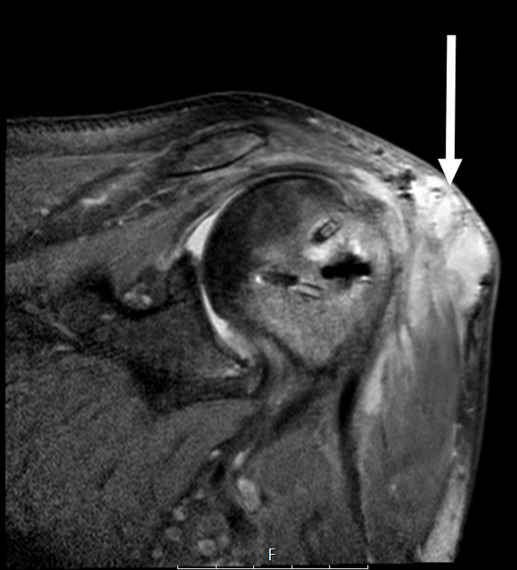 Septic Shoulder Strategies | Emergency Physicians Monthly