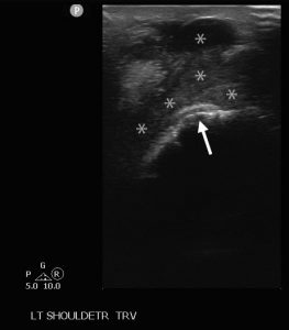 Septic Shoulder Strategies | Emergency Physicians Monthly