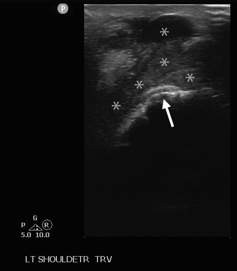 Septic Shoulder Strategies | Emergency Physicians Monthly