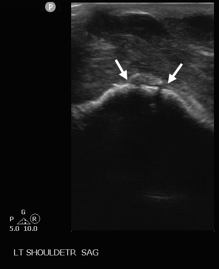 Septic Shoulder Strategies | Emergency Physicians Monthly