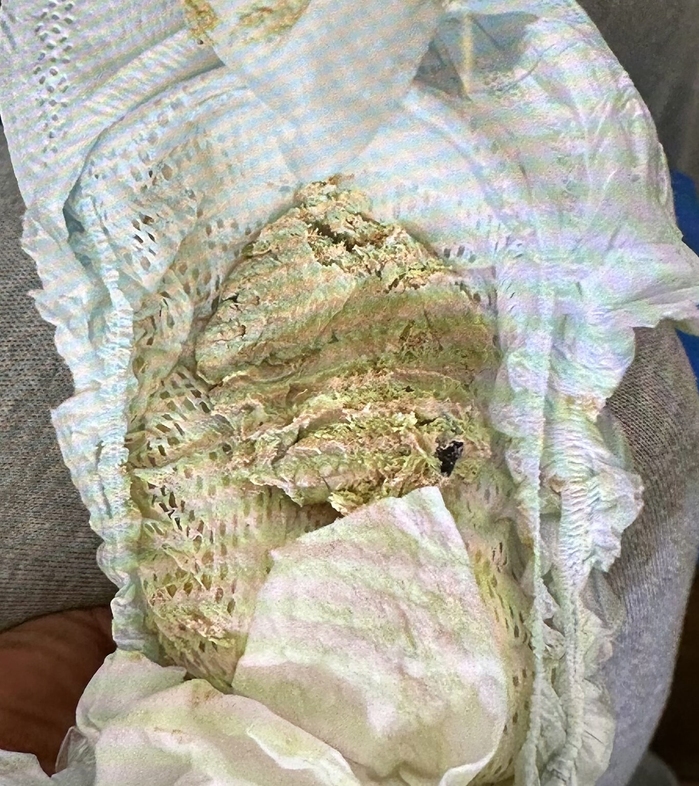 What Etiology of Clay-colored Stools in a Pediatric Patient ...